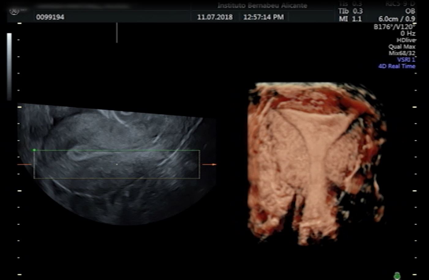 Do abnormal uterine contractions cause embryo implantation failure?